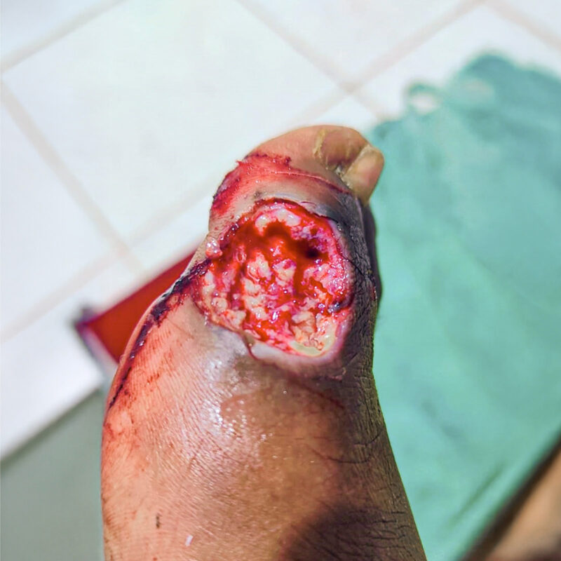 CS SUPRA SDRM - PMI – The Wound Healing Company