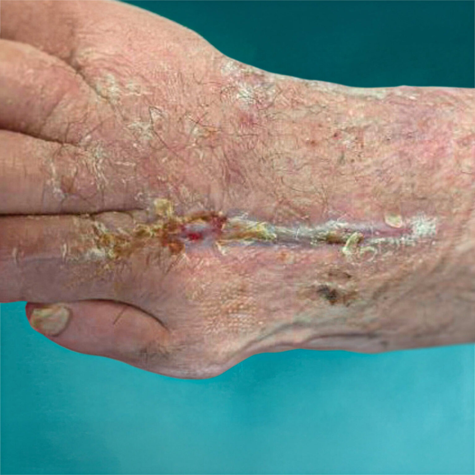 CS SUPRA SDRM - PMI – The Wound Healing Company