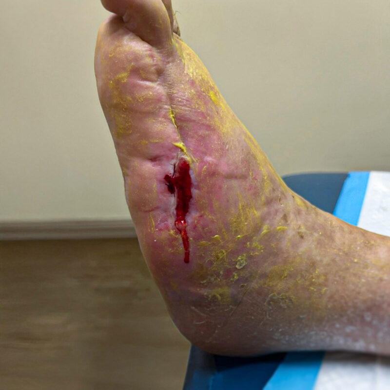 CS SUPRA SDRM - PMI – The Wound Healing Company