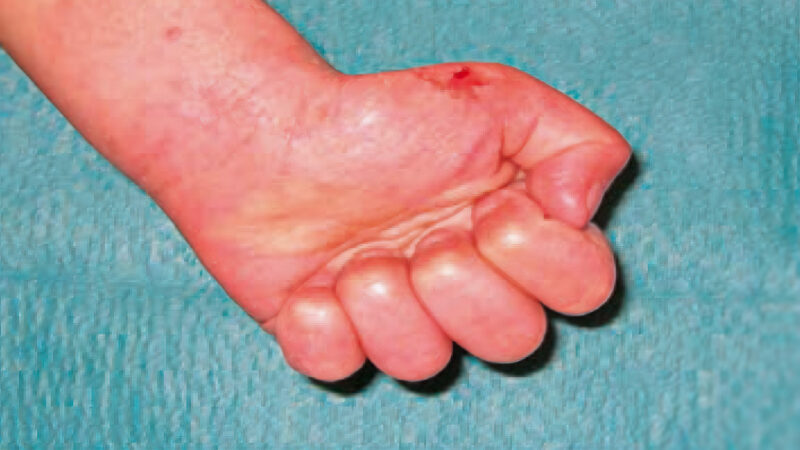 CS SUPRATHEL - PMI – The Wound Healing Company