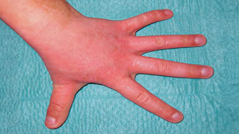 CS SUPRATHEL - PMI – The Wound Healing Company
