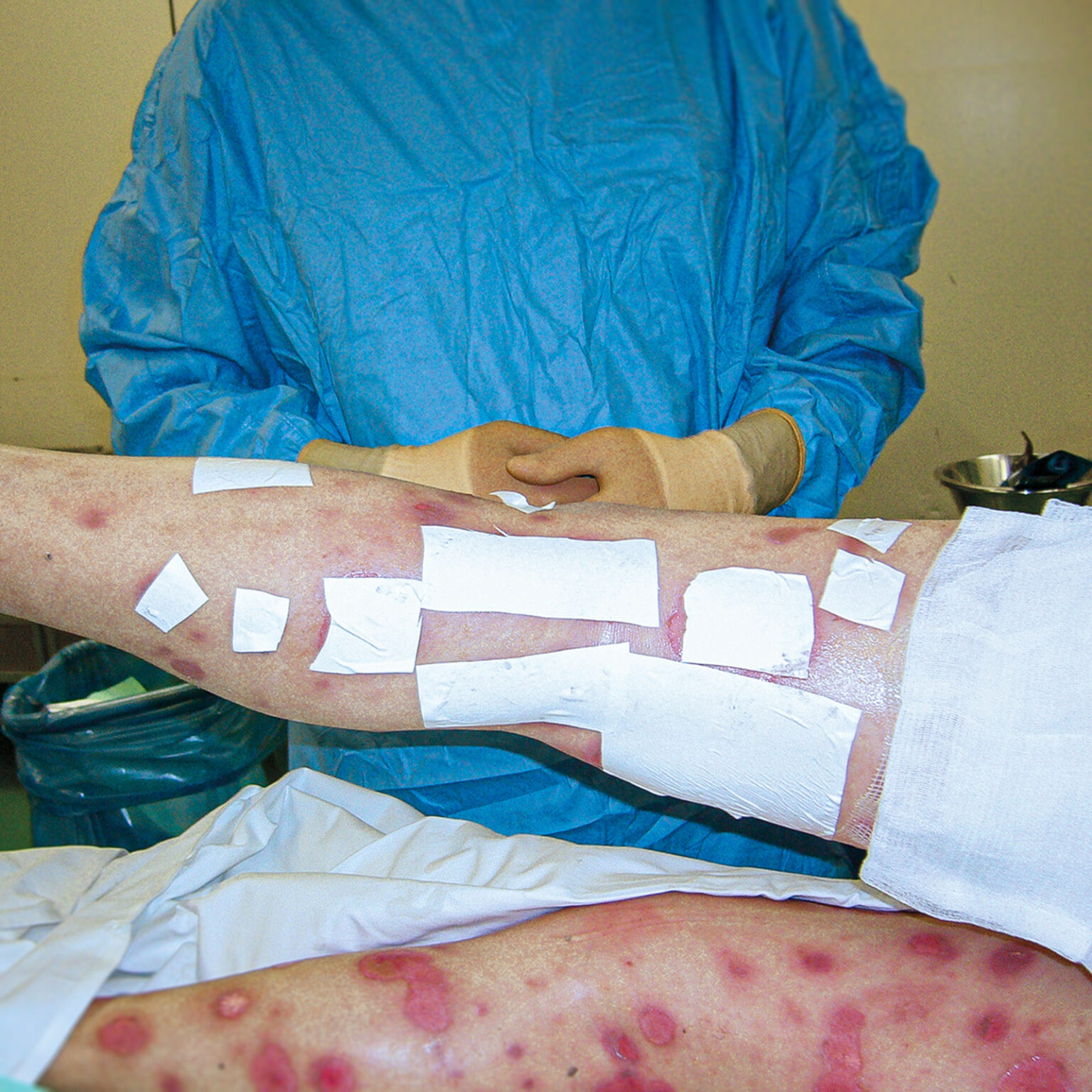 CS SUPRATHEL - PMI – The Wound Healing Company