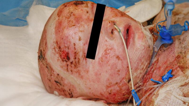 CS SUPRATHEL - PMI – The Wound Healing Company