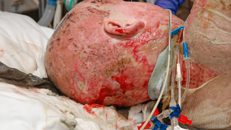 CS SUPRATHEL - PMI – The Wound Healing Company