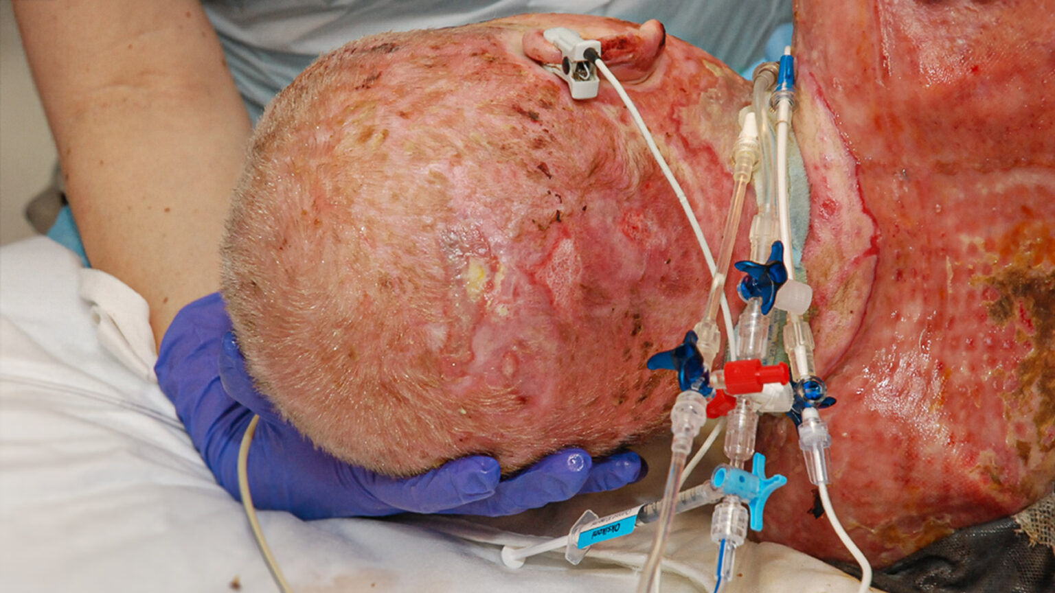 CS SUPRATHEL - PMI – The Wound Healing Company